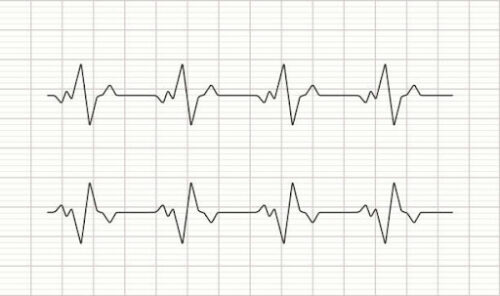 How a Defibrillator Works: the Ultimate Guide - Integrity Health & Safety